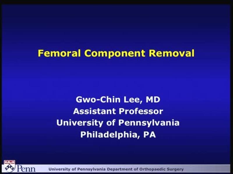 Femoral Component Removal - Orthogate