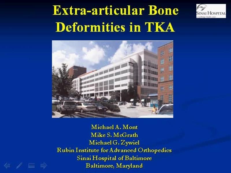 Assessing Polyethylene Wear and Osteolysis in TKA