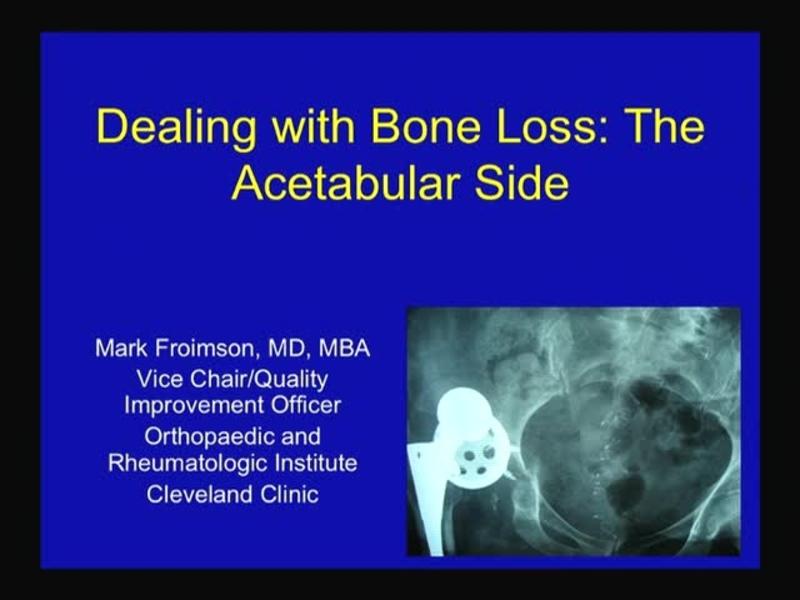 Dealing with Bone Loss - The Acetabular Side - Orthogate