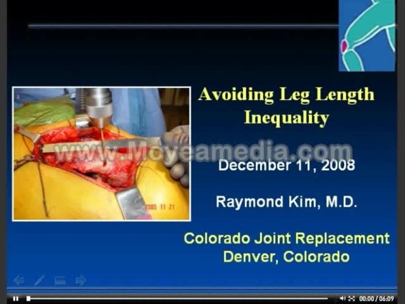 Avoiding Leg-Length Inequality in THA - Orthogate