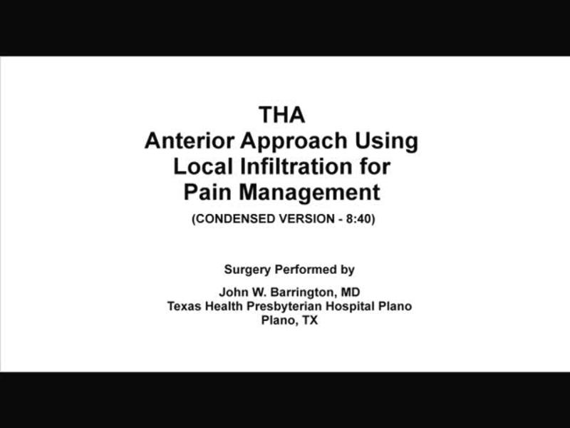 THA Anterior Approach - Using Local Infiltration for Pain Ma - Orthogate