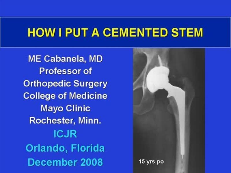 How I Put In a Cemented Femoral Stem - Orthogate